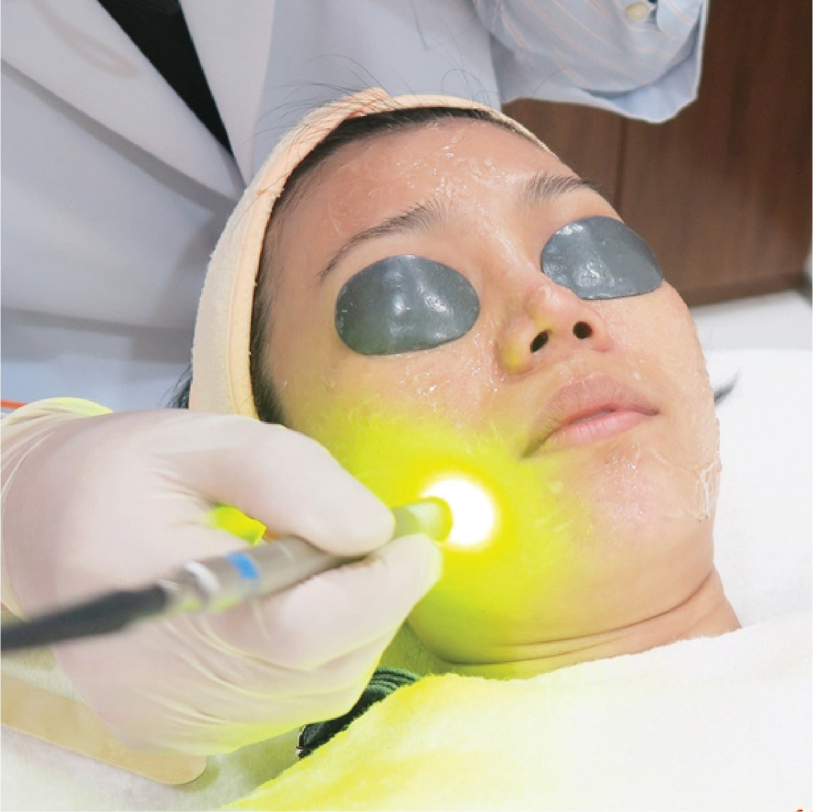 Yellow Laser – Bandung Skin Centre